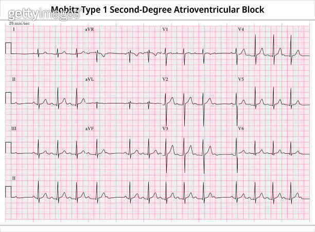 Mobitz Type 1 Second Degree Atrioventricular Block - ECG Paper 12 Lead ...