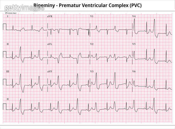 Bigeminy - Premature Ventricular Complex (PVC) - Ventricular Premature ...