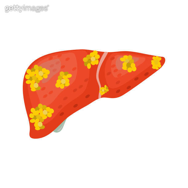 Liver cancer is a life-threatening illness and one of the fastest ...