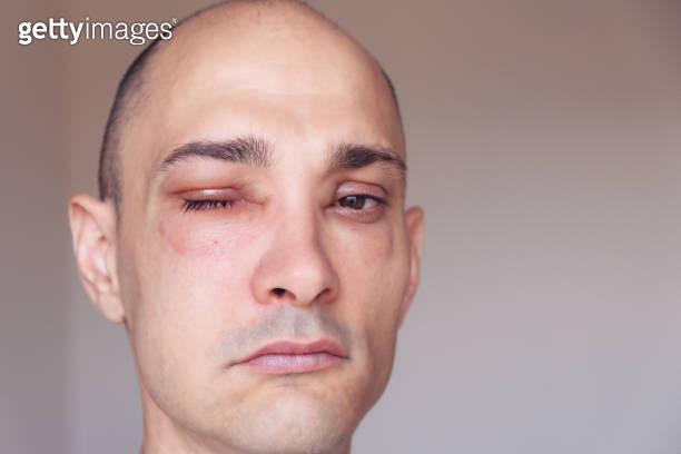 Caucasian man has angioedema around the eyes caused by allergic ...