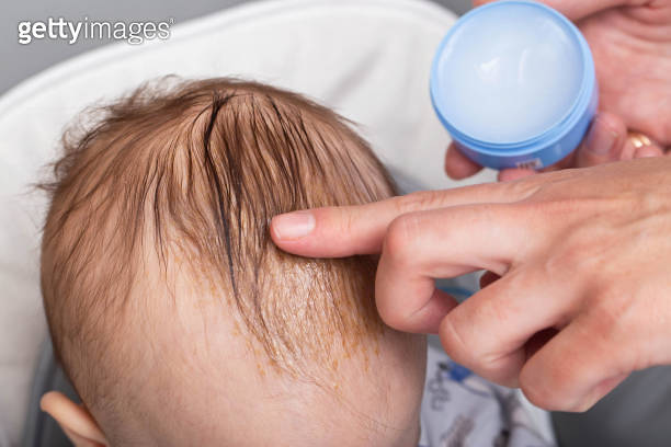Applying a special cream and oil to the child's scalp to remove gneiss ...