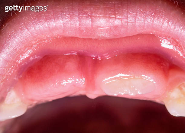 The eruption of a permanent tooth after the loss of a milk tooth in a ...
