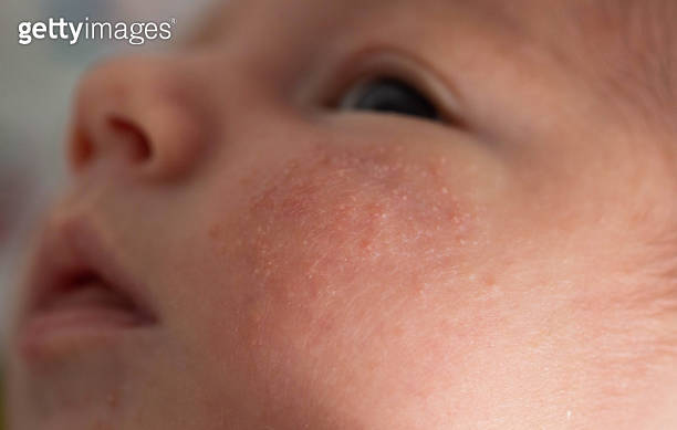 Rash on the face of a newborn baby. The process of formation of the ...
