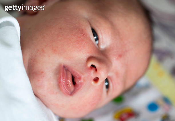 Rash on the face of a newborn baby. The process of formation of the ...