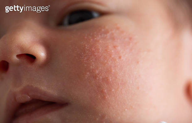 Rash on the face of a newborn baby. The process of formation of the ...