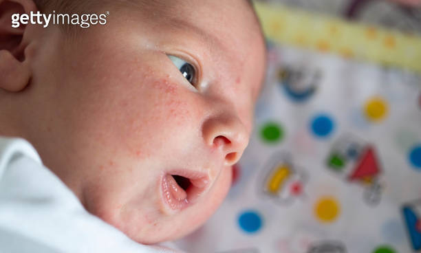 Rash on the face of a newborn baby. The process of formation of the ...