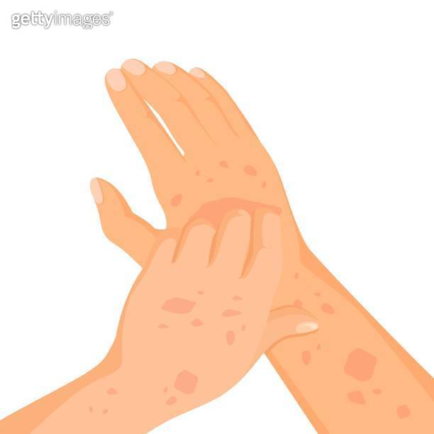 Rash skin on hand. Rashes itching hands scratch arm in red spot ...