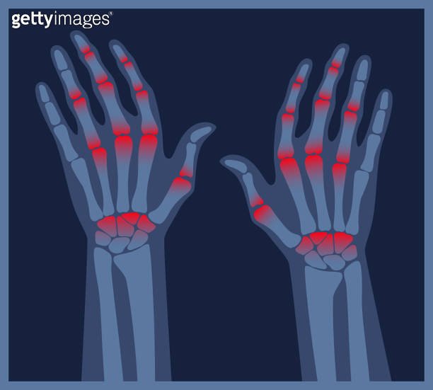Arthritis hands x-ray. Pain in the human body. Arthritis, bone disease ...