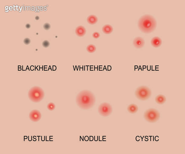 Different types of acne. Acne skin types. Blackheads, whiteheads ...