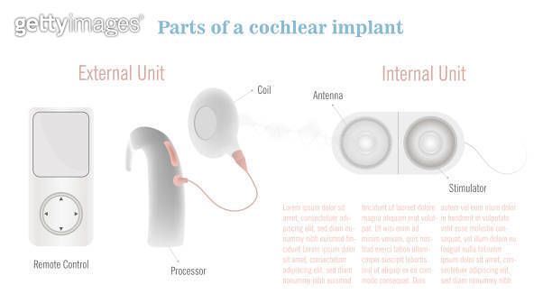 Parts of a cochlear implant from the remote control, (1847081982) - 게티이미지뱅크