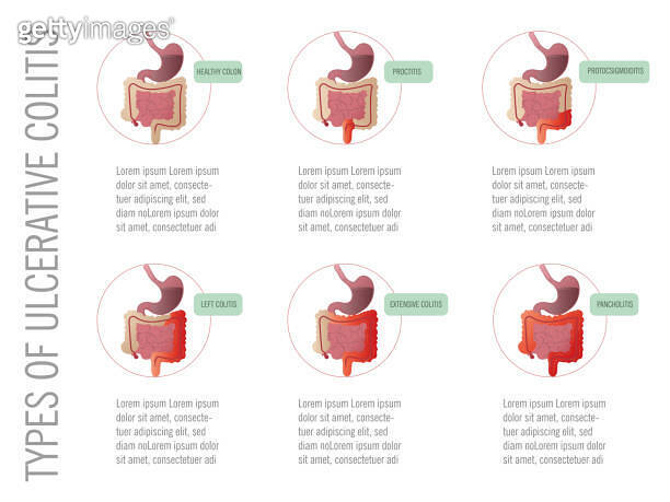 Infographic: types of ulcerative colitis (1488899476) - 게티이미지뱅크