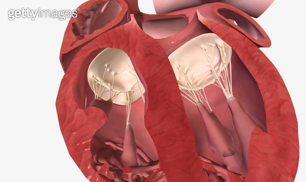 Patent foramen ovale (PFO) is an abnormal hole present in the wall ...