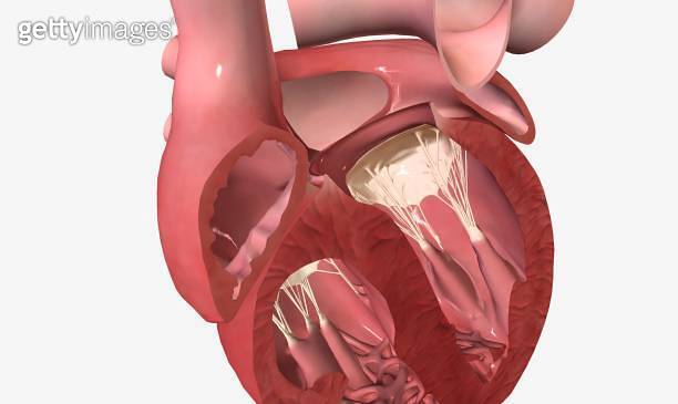 Patent foramen ovale (PFO) is an abnormal hole present in the wall ...