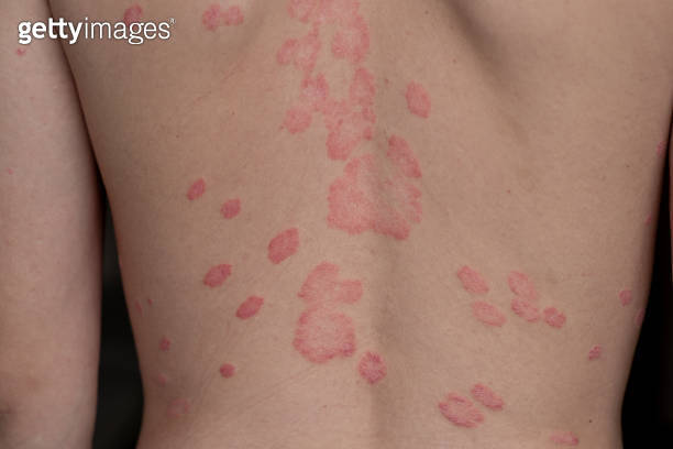 Psoriasis Vulgaris, skin patches are typically red, itchy, and scaly ...