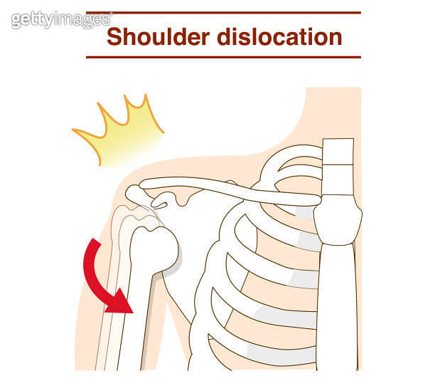 Mechanism of shoulder joint dislocation (1725526231) 일러스트, 무료 일러스트 - 게티 ...