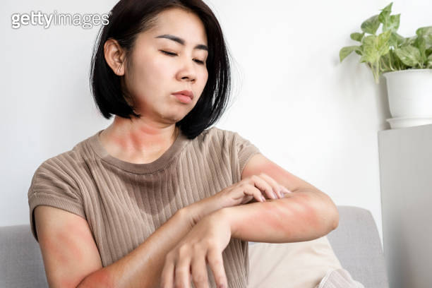 Asian woman has allergic to her own sweat hand scratching itchy, rash ...