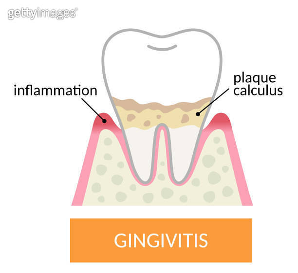 gingivitis tooth and gums. plaque and calculus build up gums and ...
