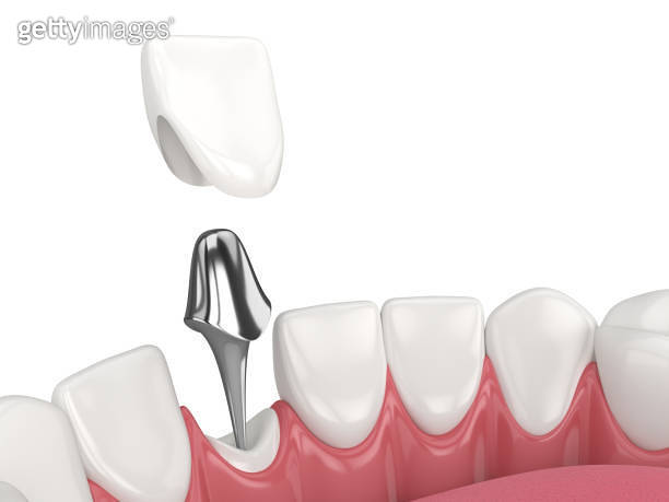 3d render of lower jaw with cast post and core tooth restoration ...