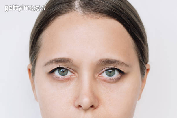 Cropped shot of a young caucasian woman's face with drooping upper ...