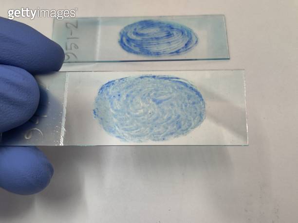 Sputum smear AFB stained glass slide. 이미지 (1759057716) - 게티이미지뱅크