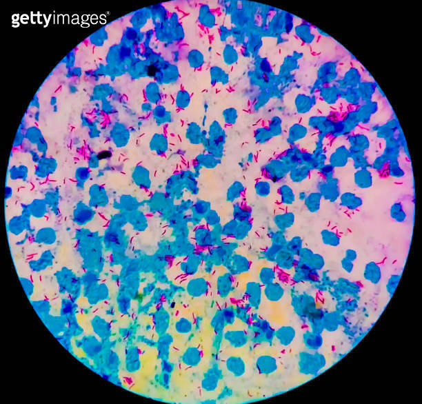 Microbacterium Tuberculosis Bacteria (MTB). 이미지 (1716366940) - 게티이미지뱅크