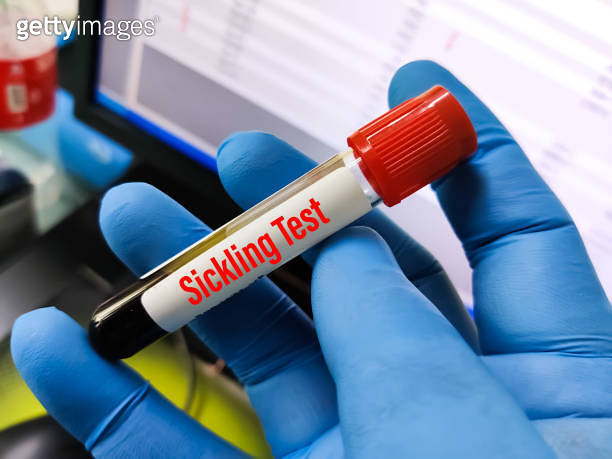 Blood sample for sickling test. 이미지 (1788773383) - 게티이미지뱅크