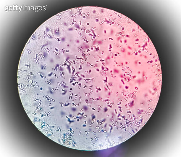 Candida Albican and Pus cells in urine sediment. 이미지 (1809349998) - 게티이미지뱅크