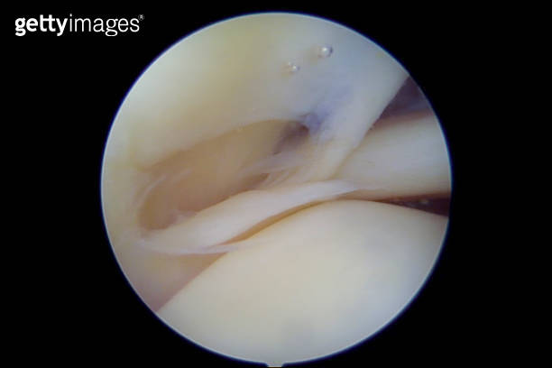 Arthroscopic view of partial supraspinatus tendon tear or PASTA lesion ...