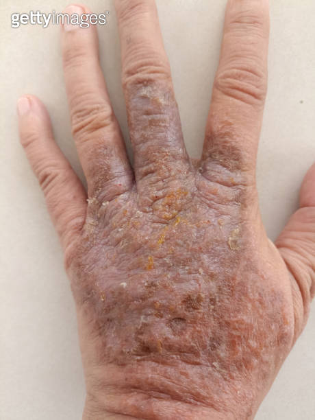 rash eczema dermatitis on finger hand. inflammation of skin (1815505745 ...