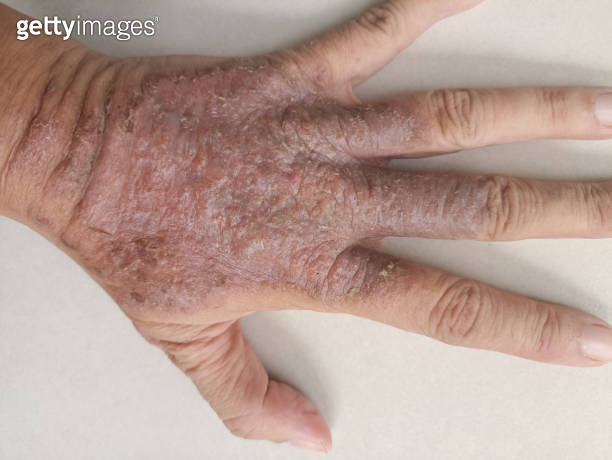 rash eczema dermatitis on finger hand. inflammation of skin 이미지 ...