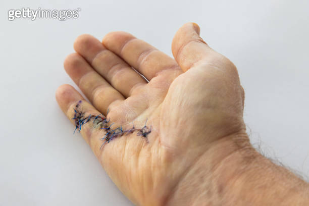 Dupuytren's contracture of little finger on man's palm after surgery ...