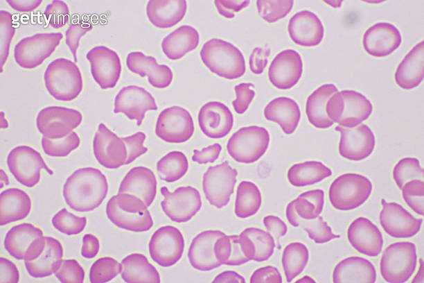 Target cells with abnormal red blood cells 이미지 (1603301443) - 게티이미지뱅크