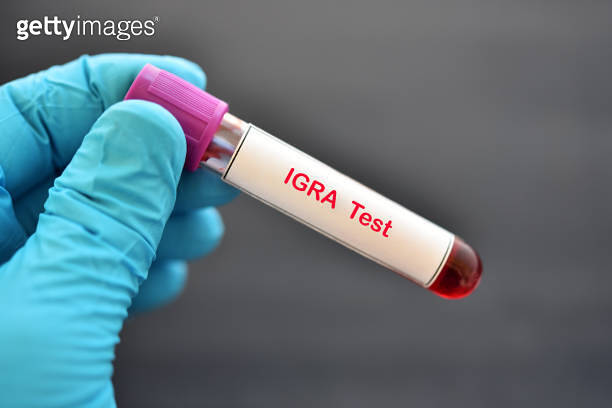 Interferon gamma release assay or IGRA test 이미지 (1646562642) - 게티이미지뱅크