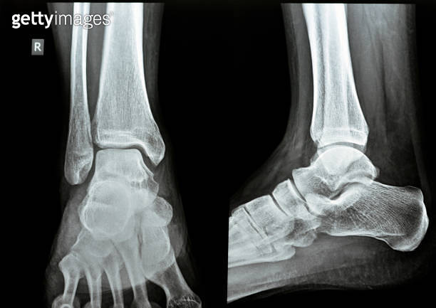 Plain x-ray AP Lateral views of the right ankle showing syndesmotic ...