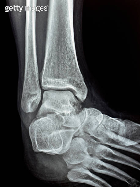 Plain x-ray mortise view of the right ankle showing syndesmotic ankle ...