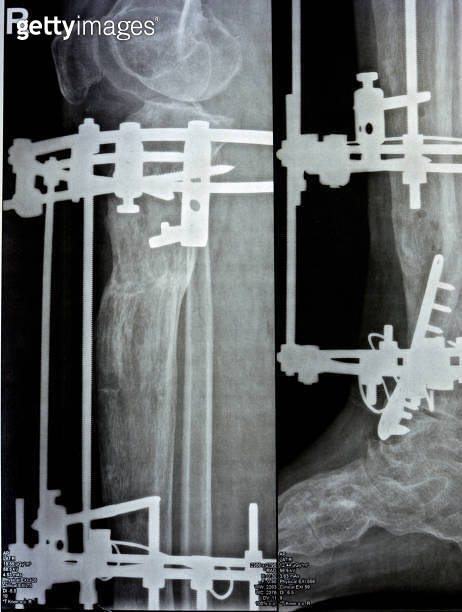 Distal comminuted fracture fibula managed by plate and screws, distal ...