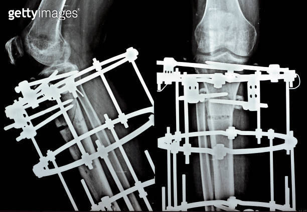 Distal comminuted fracture fibula managed by plate and screws, distal ...