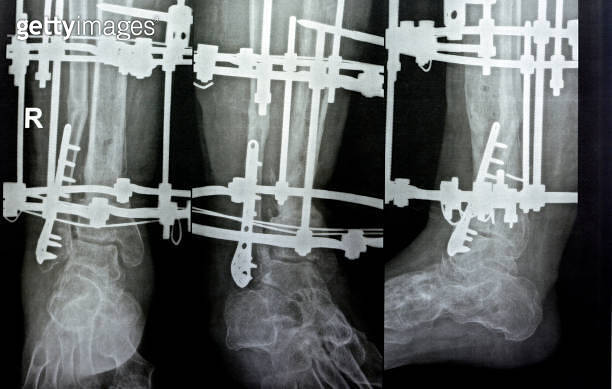 Distal comminuted fracture fibula managed by plate and screws, distal ...