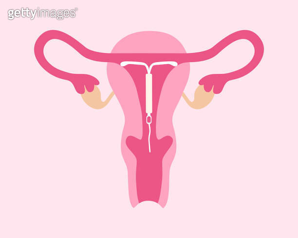 Intrauterine Device In The Uterus. IUD-Contraception Method. Birth ...
