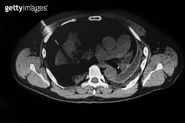 CAT - Scan: Fine needle transthoracic aspiration cytology 이미지 ...