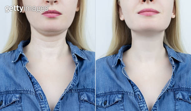 Venus rings. Skin folds on the neck due to loss of elasticity. Removal ...