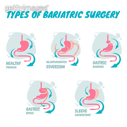 Types of bariatric surgery, it is process for the digestive system in ...