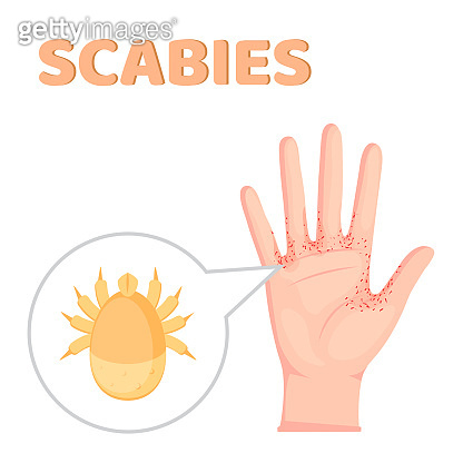 Sarcoptes scabiei. scabies. Sexually transmitted disease. Infographics ...