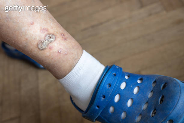 Ulcers and skin diseases, dried scabs and fresh wounds on the legs of ...