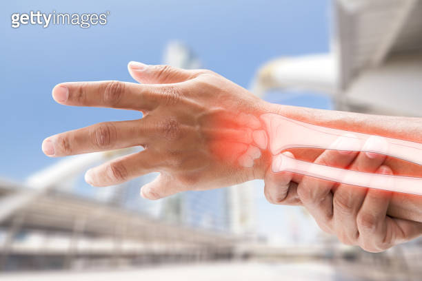 Bone disease. 이미지 (1478557934) - 게티이미지뱅크