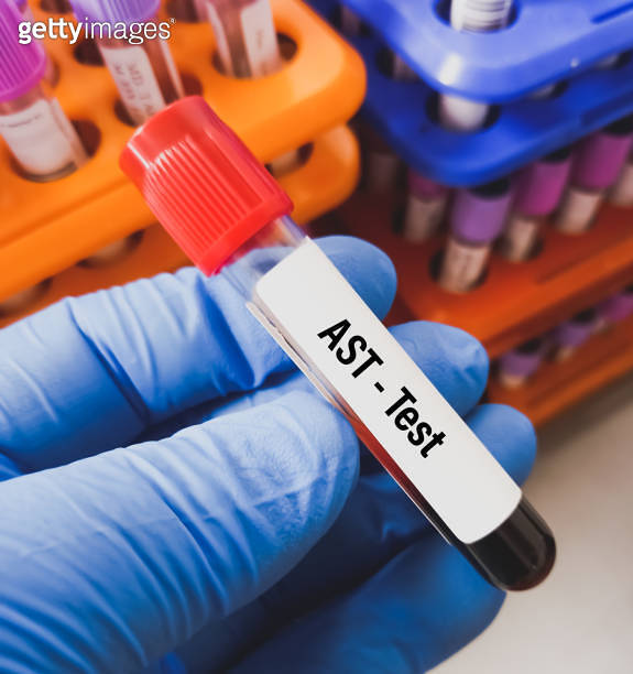 Laboratory sample tube with blood for AST (Aspartate Aminotransferase ...
