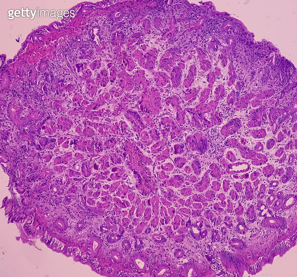 Gastric body tissue (endoscopic biopsy): Section show gastric mucosa ...