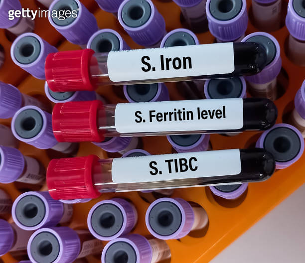 Biochemist holds blood sample for Serum Iron Profile test. Iron ...