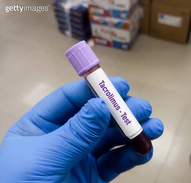 Blood sample for Tacrolimus test, immunosuppressive drug, to measure ...