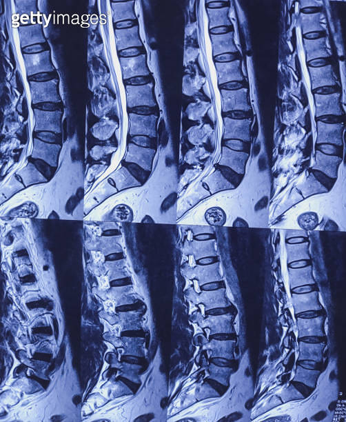 MRI (magnetic resonance imaging) of Lumbo sacral Spine. L4-L5 and L5-S1 ...